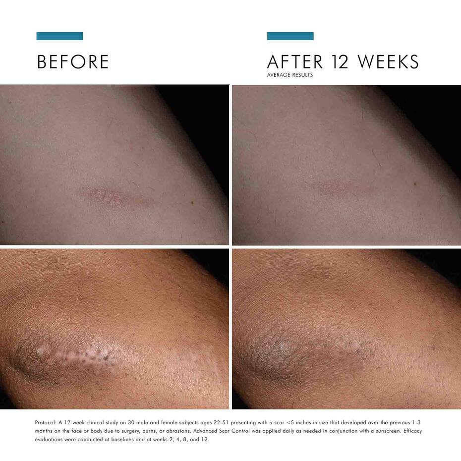 ADVANCED SCAR CONTROL – Bras Medical Spa